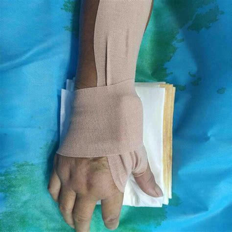 Compression Upon Distal Transradial Artery For Hemostasis Download
