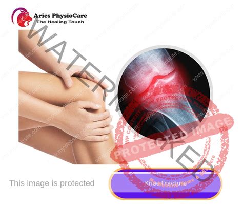 Knee Fracture Aries Physiocare