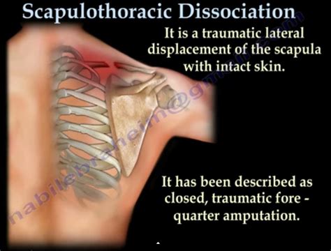 Scapulothoracic Articulation