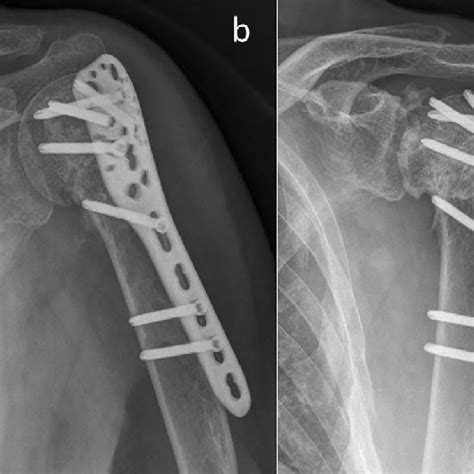 Case 3 A 73 Year Old Woman With A 4 Part Fracture Of The Left Proximal Download Scientific