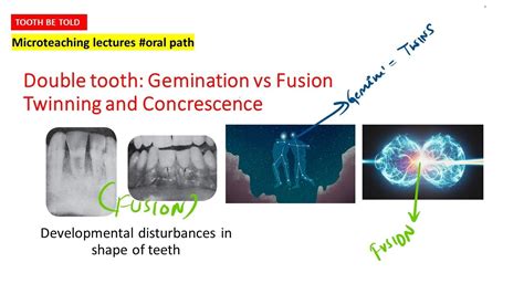 Twinning Gemination Teeth