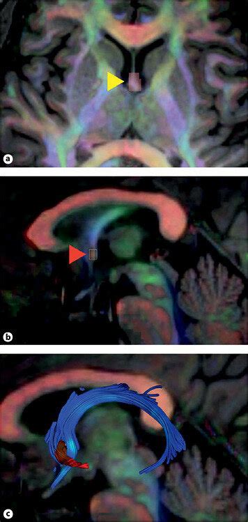 dti model reconstruction using deterministic tractography a axial