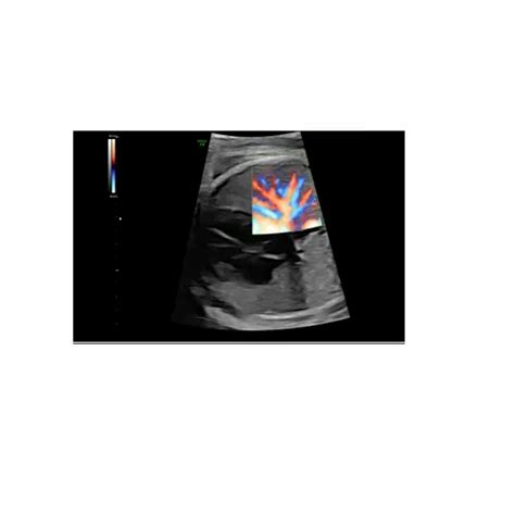 Ge Voluson E6 Bt13 Ultrasound Machine At Rs 2200000 Ge Ultrasound Machine In Kozhikode Id