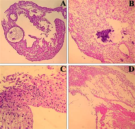 Pathology Findings A Pseudodecidualized Endometrium Presence Of Download Scientific Diagram