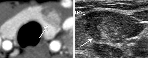 Significance Of Incidental Thyroid Lesions Detected On Ct Correlation
