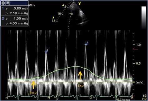 Echocardiographic Diagnosis Of Constrictive Pericarditis Circulation