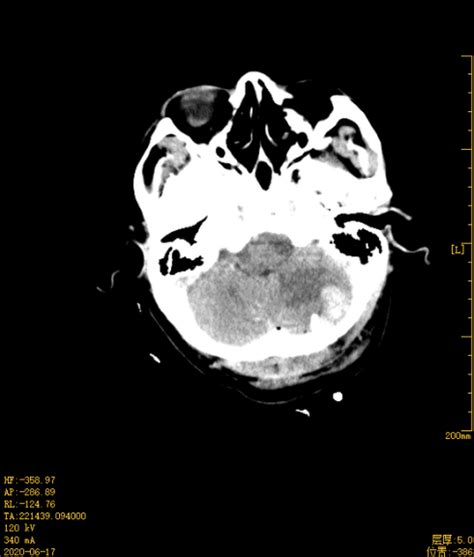 先进3D技术对颅内血肿的精准治疗 医学界 助力医生临床决策和职业成长