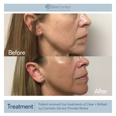Clear And Brilliant By Md Skincenter In Rockford