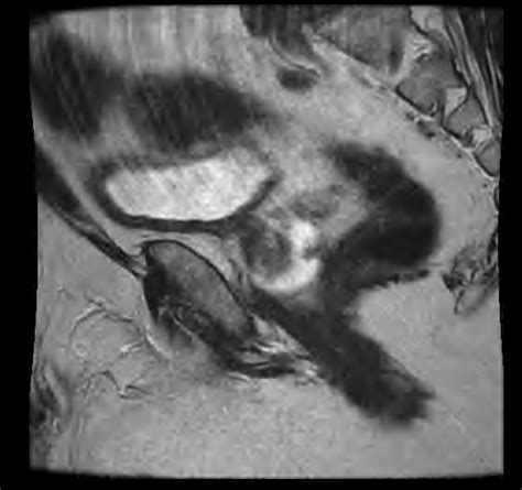 High Image Compression Applied On A Study With Jpeg2000 Lossless