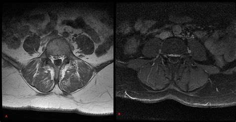 Lumbar Spine Mri Axial Approach To Mri Spine