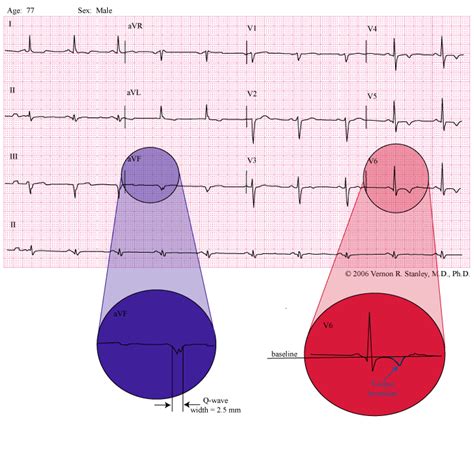 T Is For T Wave Inversion ECGcourse Com