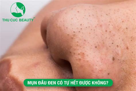 Mụn đầu đen Có Tự Hết được Không Bệnh Viện Phẫu Thuật Thẩm Mỹ Thu Cúc