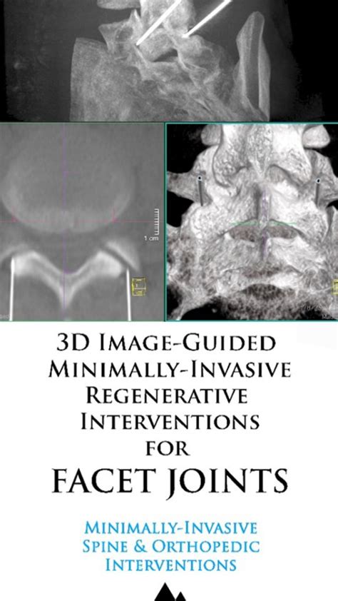 Alpine Spine And Orthopedics Institute Alpinespineorthopedics • Instagram Photos And Videos