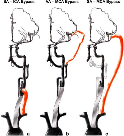 The Surgical Revascularization Strategies For The Treatment Of Common Download Scientific