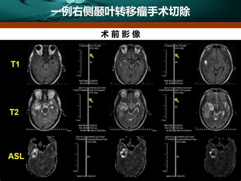 王拓教授团队：一例右侧颞叶转移瘤手术切除 脑医汇