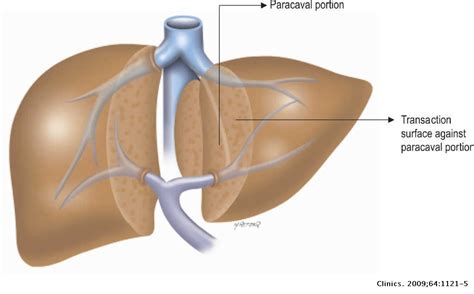 Anterior Hepatic Transection For Caudate Lobectomy Clinics