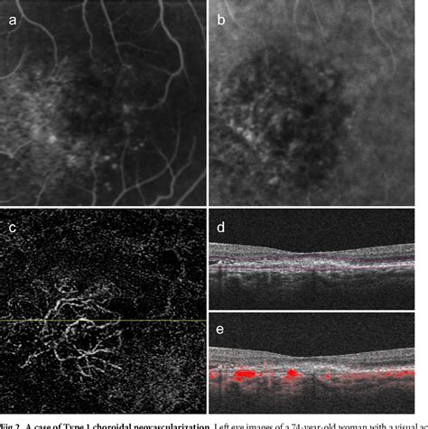 Figure 1 From Vascular Maturity Of Type 1 And Type 2 Choroidal Neovascularization Evaluated By
