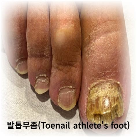 불편한 발톱 뒤에 숨은 무좀 발톱무좀 증상 8가지와 치료 방법 Elounlife Blog