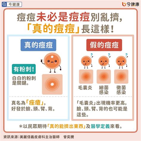 痘痘怎麼擠頭頂的怎處理醫指成功擠破2關鍵 beanfun