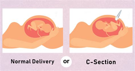 Pictures Of Normal Delivery