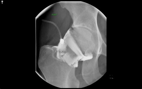 Arthrogram（联合x射线）：目的，程序，风险，结果 关节炎 2025