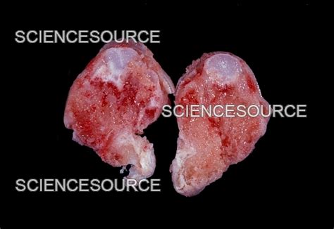 Human Tibia Osteochondroma Gross Spec Stock Image Science Source Images