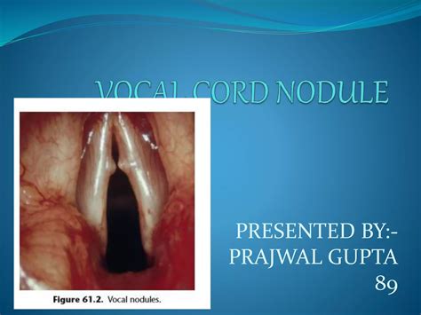 Vocal Cord Nodule Pptx