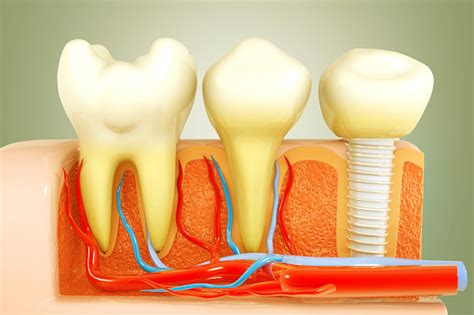 치과 임플란트 치아 임플란트 인간의 치아 또는 의치 수술 3d 그림 3차원 형태에 대한 스톡 사진 및 기타 이미지 3차원 형태 건강관리와 의술 깨끗한 Istock