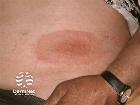 Erythema Migrans Images
