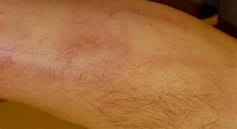 Tromboflebitis Upala Vena Simptomi Uzrok Obloge I Lečenje