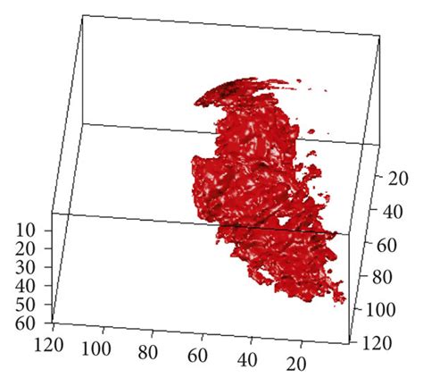 3d Tumor Segmentation Results Of Case 3 Obtained With Different