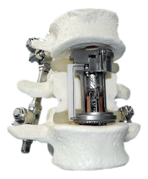 Vertebral Body Replacement Orthoload