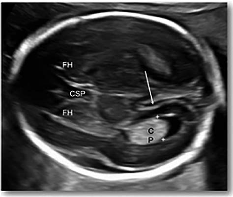Correct Measurement Of The Atrium Of The Lateral Ventricle On The Axial Download Scientific Correct Measurement Of The Atrium Of The Lateral Ventricle On The Axial Download Scientific