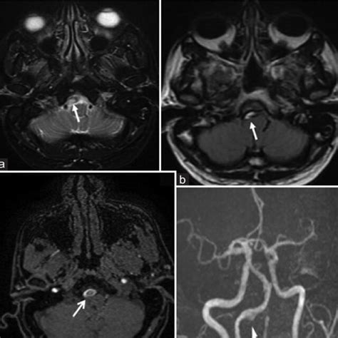 Partially Thrombosed Fusiform Aneurysm A 55 Year Old Male Presented Download Scientific
