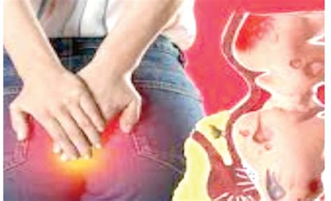 Persons Engaging In Anal Sex More At Risk Of Anal Cancer Oncologist Warns Punch Newspapers