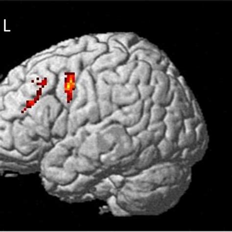 Increased Working Memory Related Functional Mri Activation