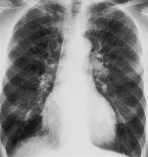 Imagechronic Obstructive Pulmonary Disease Chest X Ray Msd Manual