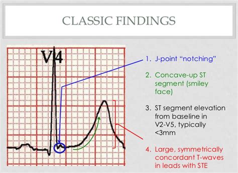 Pericarditis Vs Stemi Ecg