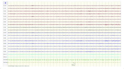 Resolution Of The Burst Suppression Pattern And Normalization Of The Download Scientific