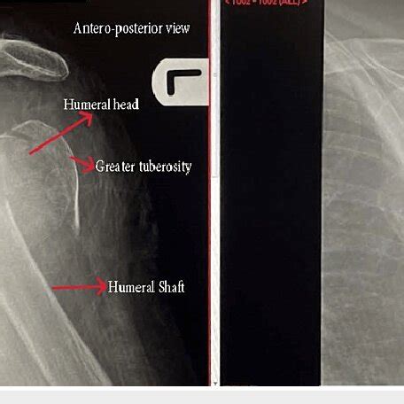 Comminuted Fracture Proximal Humerus Un Reconstructible Proximal Download Scientific Diagram
