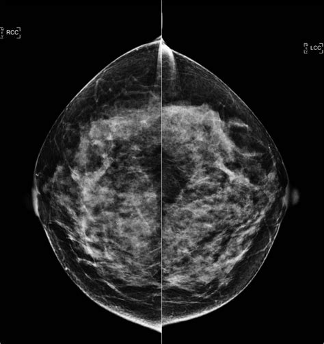 Image Iq Ultrasound Screening Of Dense Breasts
