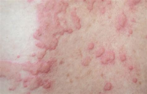 Understanding Hiv Rash Symptoms Treatment And Identification