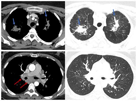 Spirometry Sarcoidosis At Grace Makin Blog