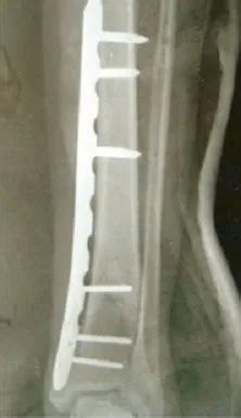 Tibial Fracture Robert Sheinberg DPM Weston FL Podiatrist