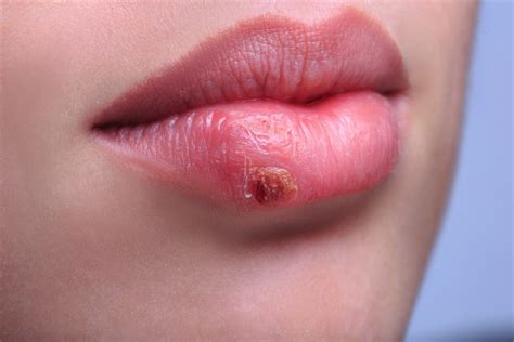 Natural Treatments For Cold Sores Herbs And Nutrients To Treat And Prevent