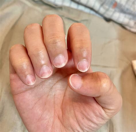 問題 甲床分離的改善方法？ 美甲板 Dcard