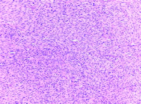 Highly Cellular Mass Of Mitotically Active Spindle Shaped Neoplastic