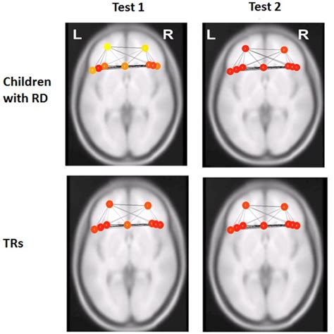 Greater Functional Connectivity In The Cingulo Opercular Network After Download Scientific