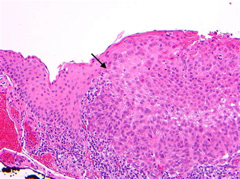 Pathology Outlines Squamous Papillomaconjunctiva