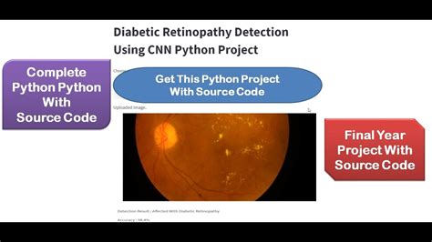 Diabetic Retinopathy Detection Using Cnn With Source Code Predict